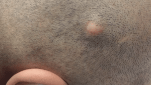 Understanding Cysts: Pilar, Sebaceous & Epidermoid - Beauty And Blog