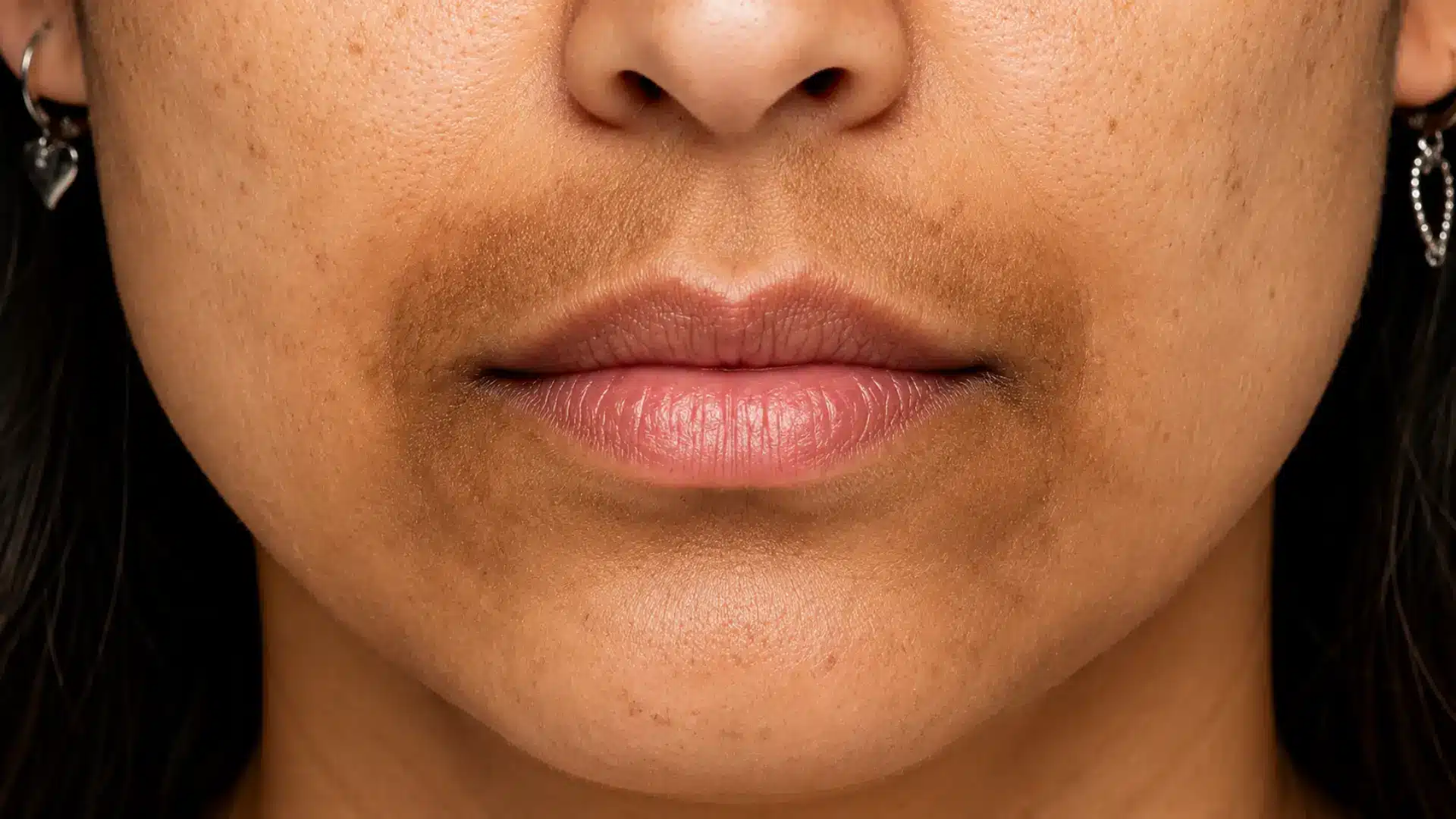 Hyperpigmentation Around Mouth: What Helps